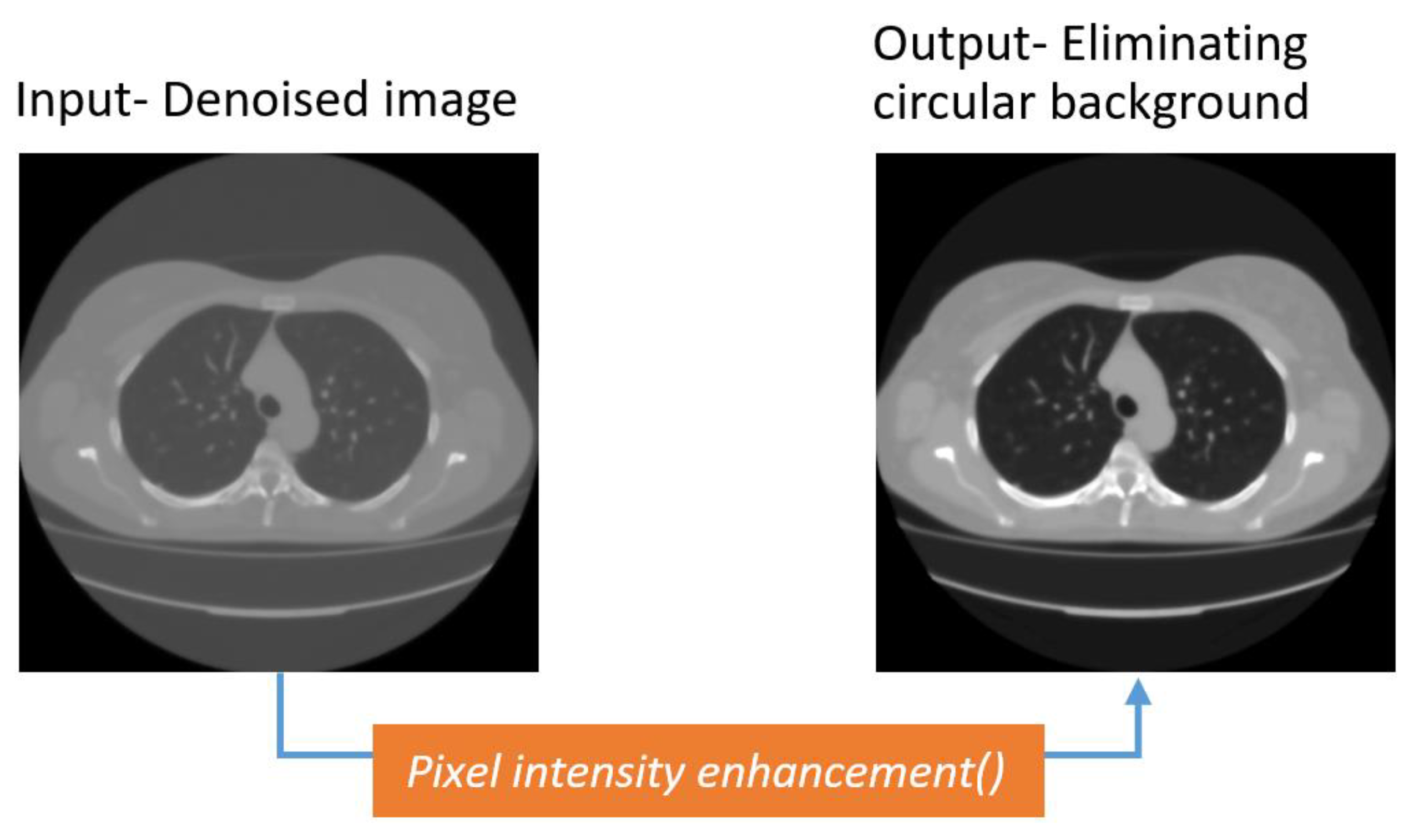 Automated Detection of Broncho-Arterial Pairs Using CT Scans Employing ...