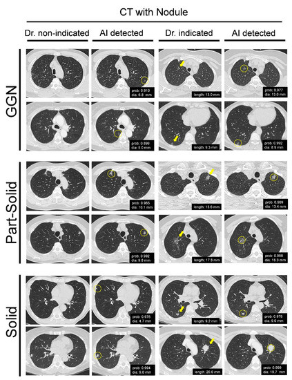 Artificial Intelligence Assisted Computational Tomographic Detection of ...