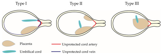 Current Evidence on Vasa Previa without Velamentous Cord Insertion or ...