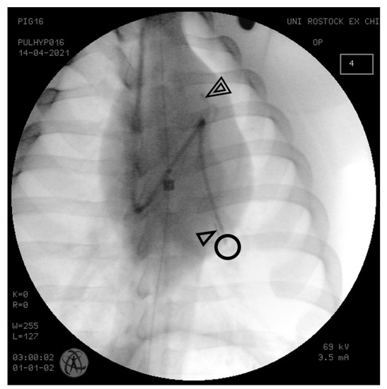 Ventilation Induces Changes in Pulse Wave Transit Time in the Pulmonary ...