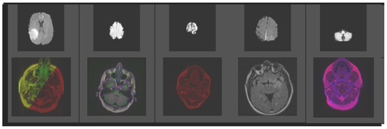 Computer-Aided Early Melanoma Brain-Tumor Detection Using Deep-Learning ...