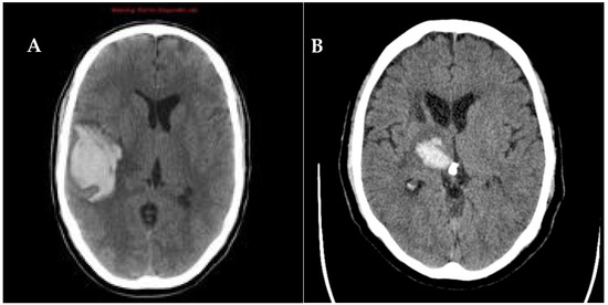 Acute Spontaneous Lobar Cerebral Hemorrhages Present a Different ...