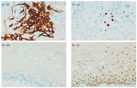 Expression of E4 Protein and HPV Major Capsid Protein (L1) as A Novel Combination in Squamous ...
