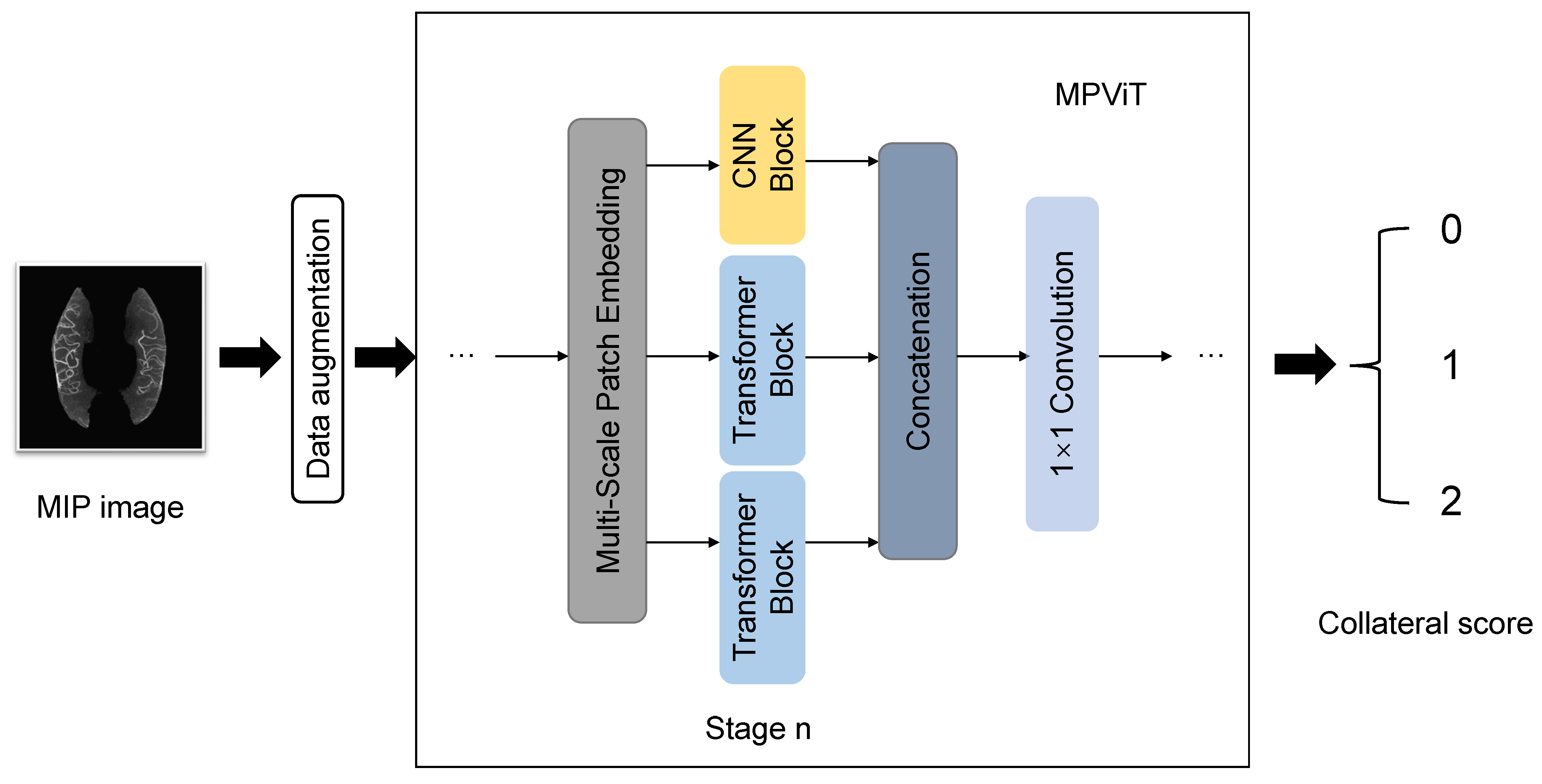 Automated Collateral Scoring on CT Angiography of Patients with Acute Ischemic Stroke Using ...