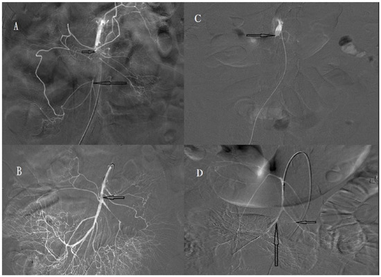 Intra-Arterial Urokinase for Acute Superior Mesenteric Artery Occlusion ...