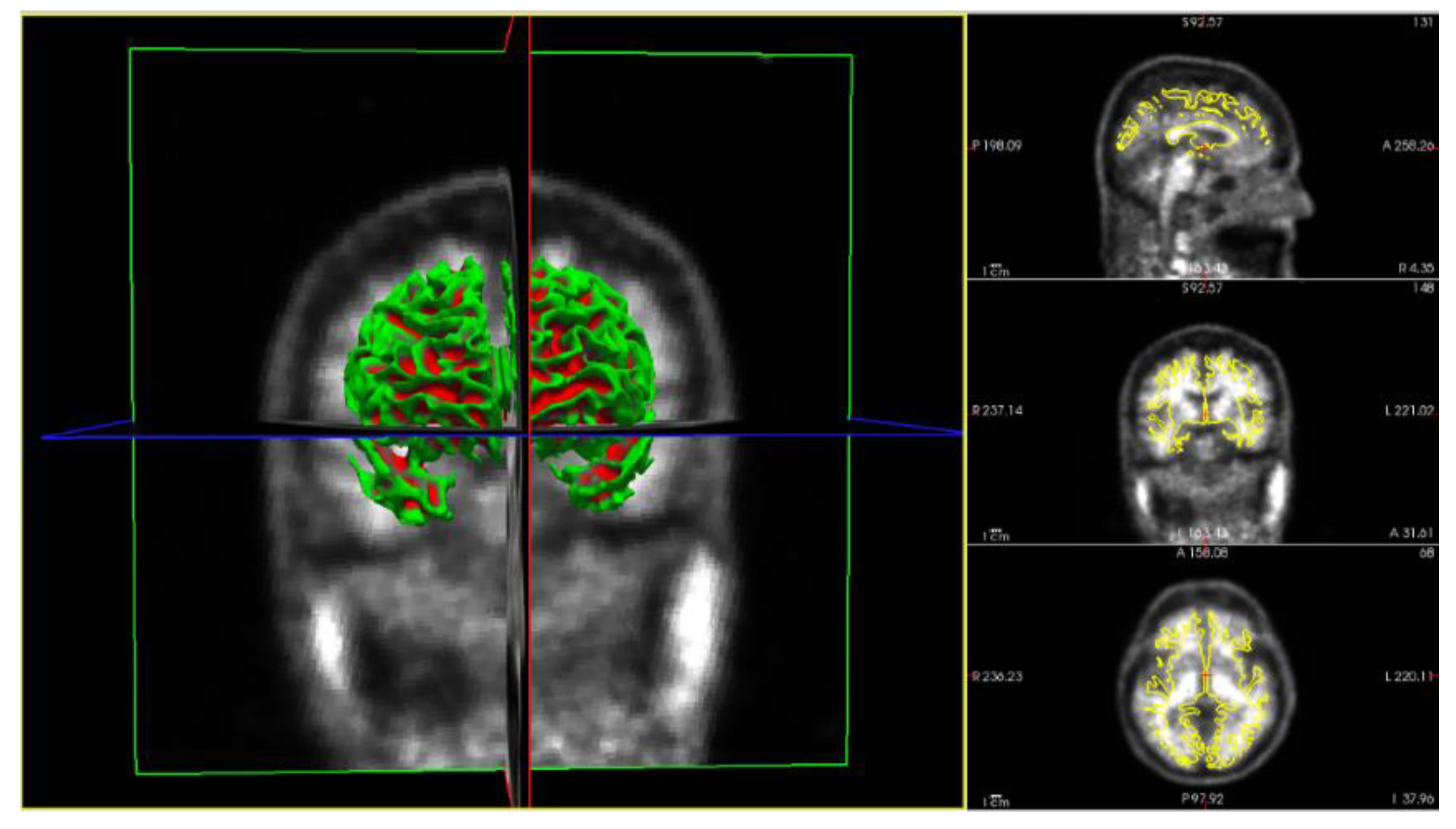 Data-Driven Phenotyping of Alzheimer’s Disease under Epigenetic Conditions Using Partial Volume ...