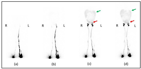 Lympho-SPECT/CT as a Key Tool in the Management of a Patient with ...