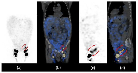Lympho-SPECT/CT as a Key Tool in the Management of a Patient with ...