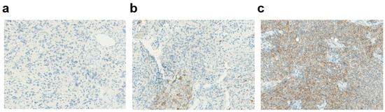 Analysis of PD-L1 and CD3 Expression in Glioblastoma Patients and ...