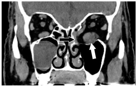 Graves’ Eye Disease: Clinical and Radiological Diagnosis