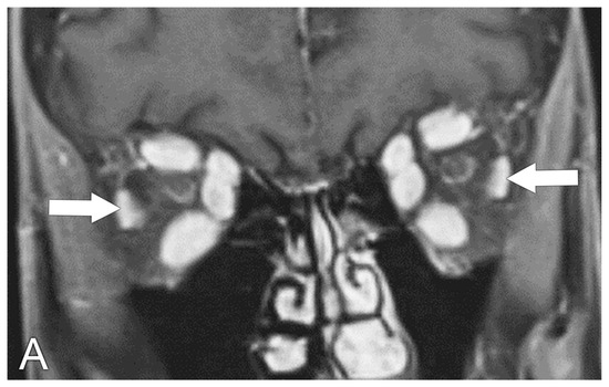 Graves’ Eye Disease: Clinical and Radiological Diagnosis