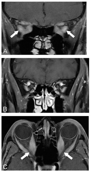 Graves’ Eye Disease: Clinical and Radiological Diagnosis
