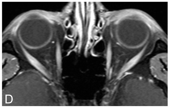 Graves’ Eye Disease: Clinical and Radiological Diagnosis