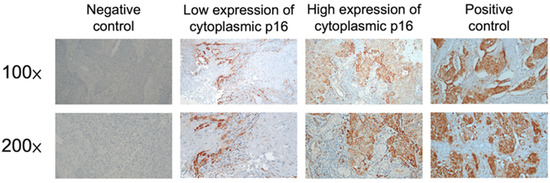 Biomedicines | Free Full-Text | Low p16 Cytoplasmic Staining Predicts ...
