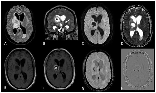 Magnetic Resonance Imaging of Primary Adult Brain Tumors: State of the ...