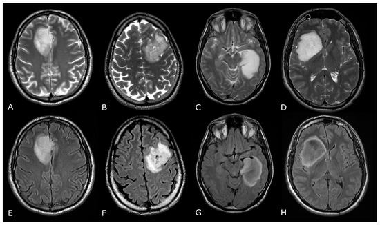 Magnetic Resonance Imaging of Primary Adult Brain Tumors: State of the Art and Future Perspectives