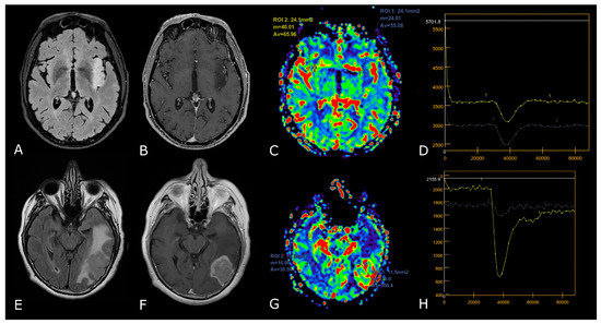 Biomedicines Free Full Text Magnetic Resonance Imaging Of Primary Adult Brain Tumors State