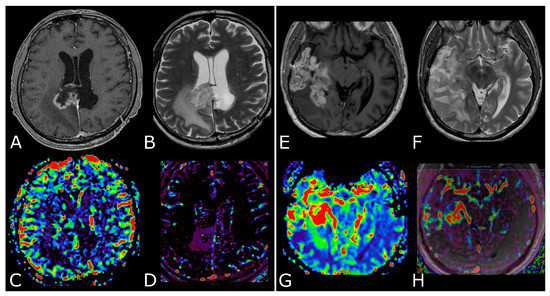 Magnetic Resonance Imaging of Primary Adult Brain Tumors: State of the ...