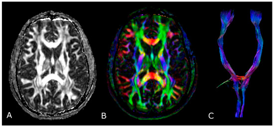Magnetic Resonance Imaging of Primary Adult Brain Tumors: State of the ...