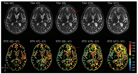 Biomedicines Free Full Text Magnetic Resonance Imaging Of Primary Adult Brain Tumors State