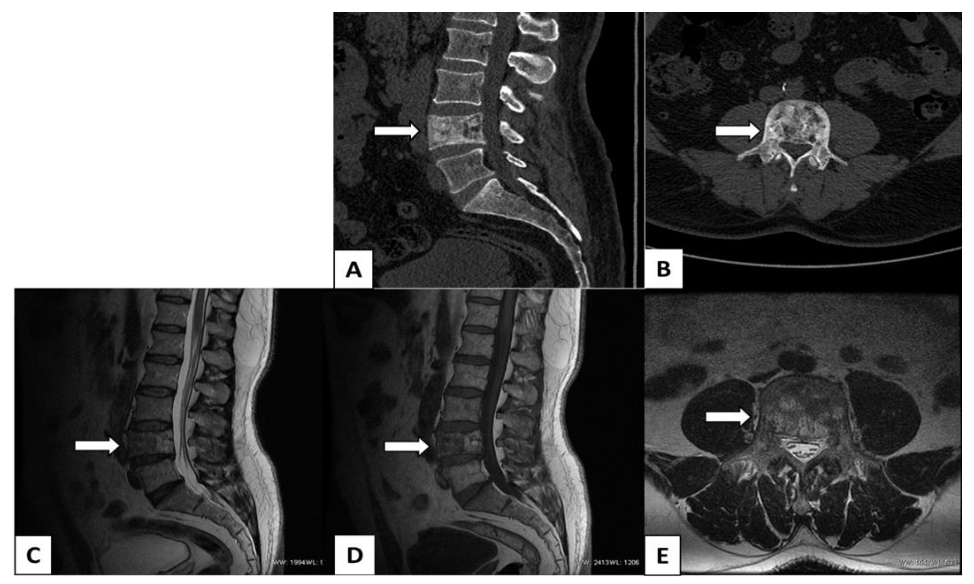 Pagets Disease Spine