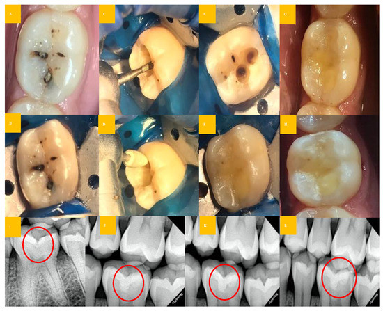 Diagnosis and Assessment of Dental Caries Using Novel Bioactive Caries ...