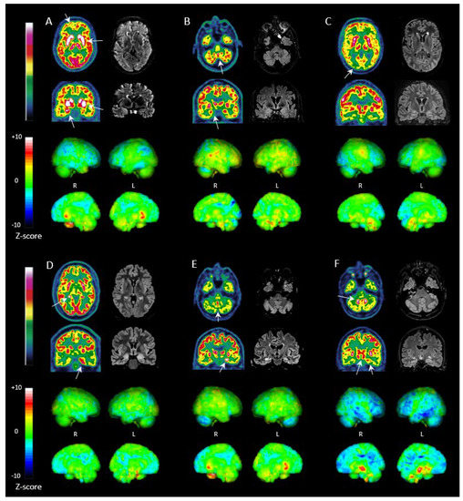 Brain Metabolic Alterations in Seropositive Autoimmune Encephalitis: An ...