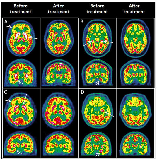 Brain Metabolic Alterations in Seropositive Autoimmune Encephalitis: An ...