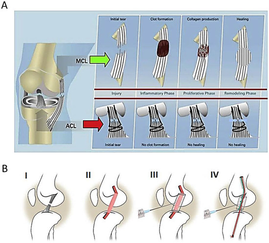 Advanced Graft Development Approaches for ACL Reconstruction or ...