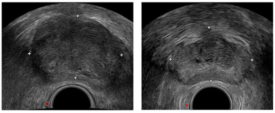 Prostate Ultrasound Image Segmentation Based on DSU-Net