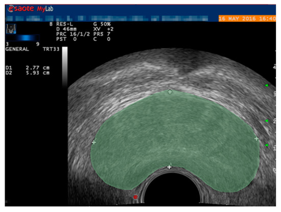 Prostate Ultrasound Image Segmentation Based on DSU-Net