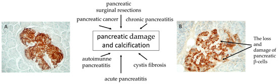 The Cause and Effect Relationship of Diabetes after Acute Pancreatitis