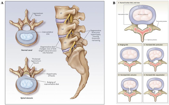 Differentiating Lumbar Spinal Etiology from Peripheral Plexopathies