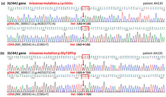 Novel Variant of the SLC4A1 Gene Associated with Hereditary Spherocytosis