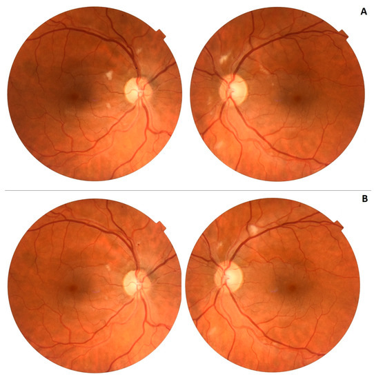 Purtscher-like Retinopathy in a Patient with Systemic Sclerosis: A Case ...