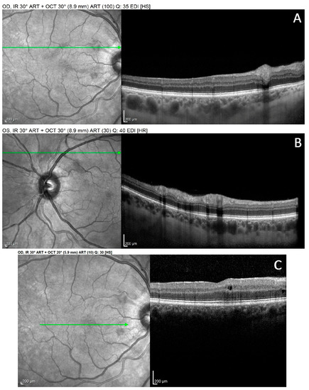Purtscher-like Retinopathy in a Patient with Systemic Sclerosis: A Case ...