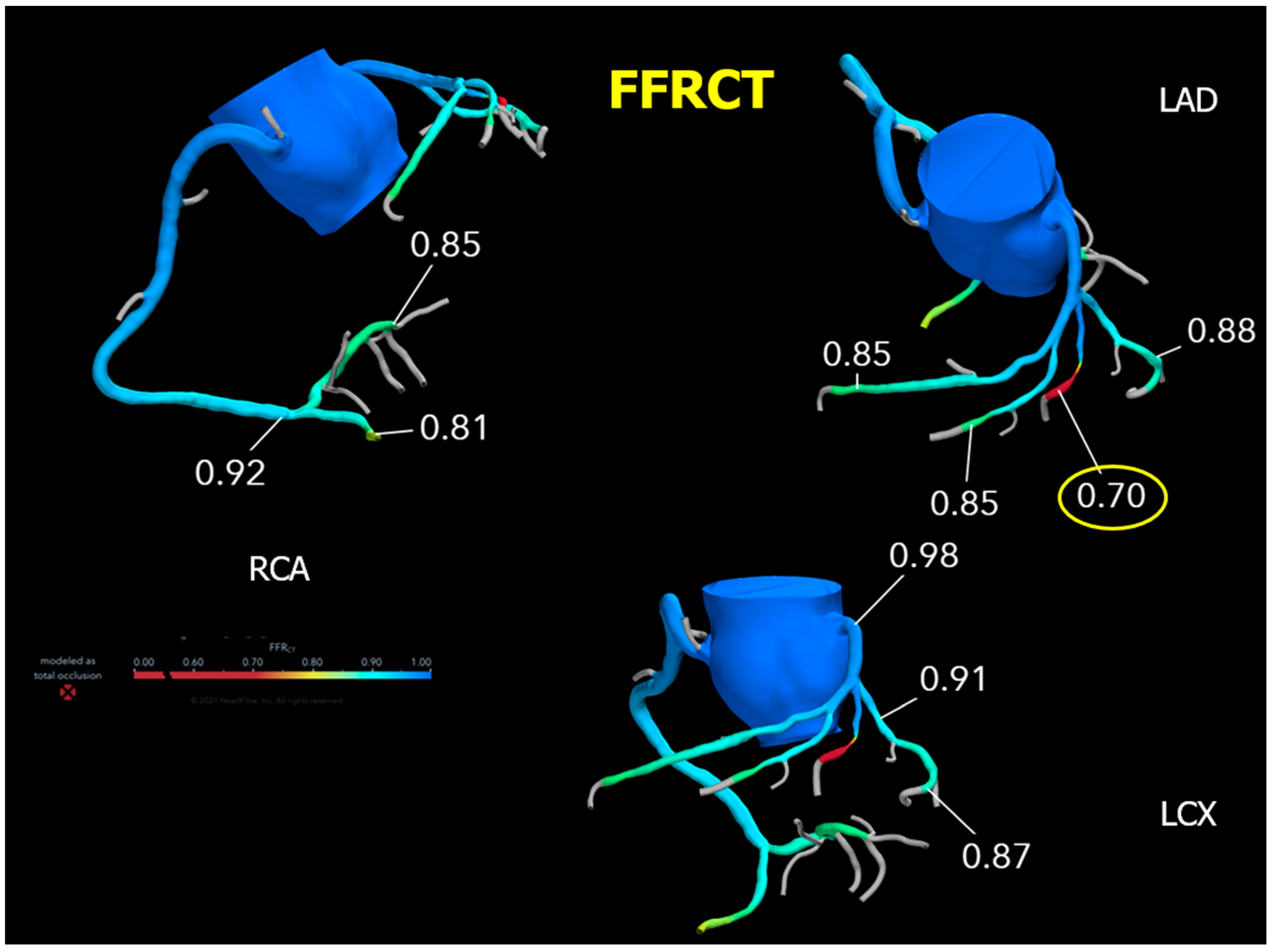 Discordance between Invasive and Non-Invasive Coronary Angiography: An ...