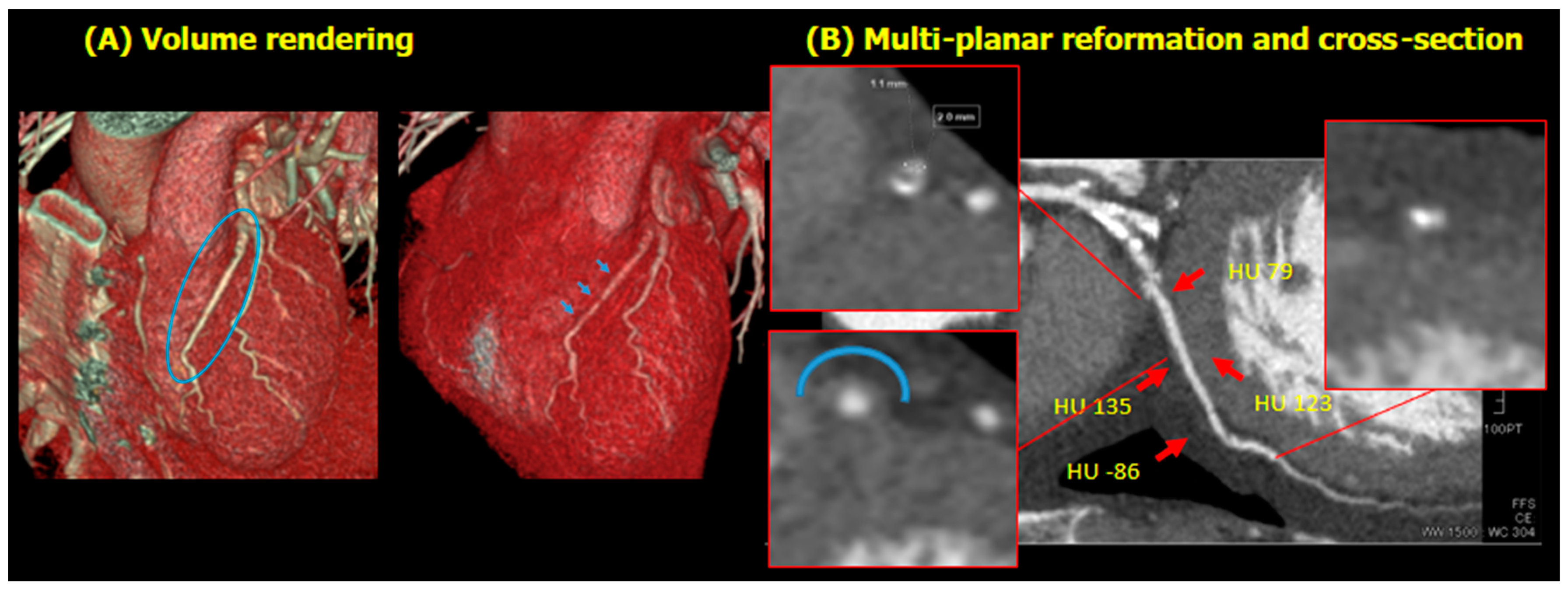 Discordance between Invasive and Non-Invasive Coronary Angiography: An ...