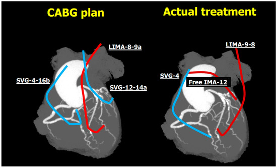 Discordance between Invasive and Non-Invasive Coronary Angiography: An ...