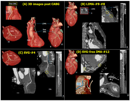 Discordance between Invasive and Non-Invasive Coronary Angiography: An ...