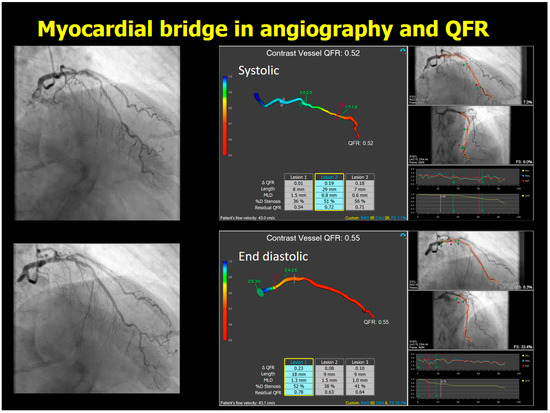 Discordance between Invasive and Non-Invasive Coronary Angiography: An In-Depth Functional and ...