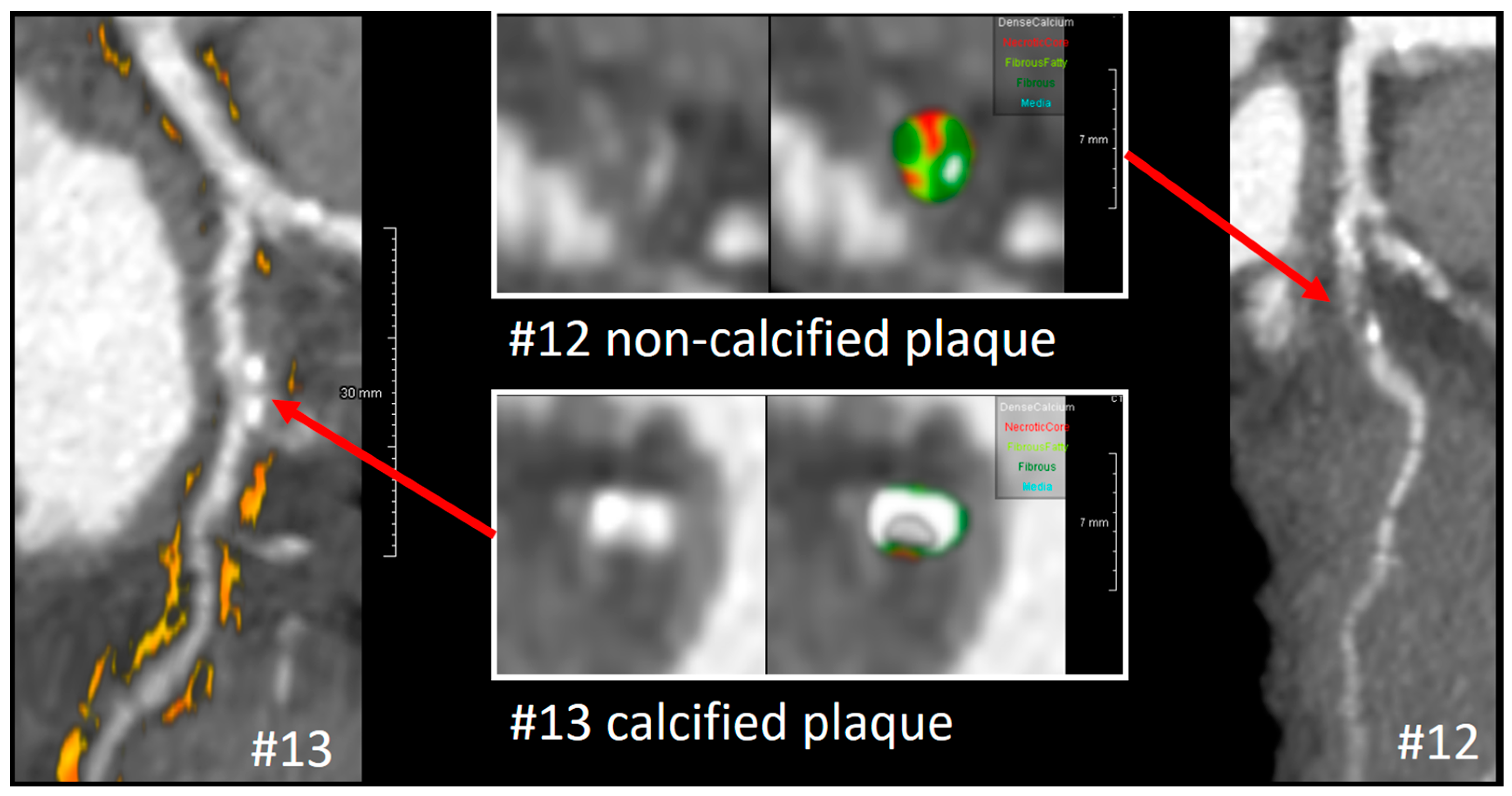 Discordance between Invasive and Non-Invasive Coronary Angiography: An In-Depth Functional and ...