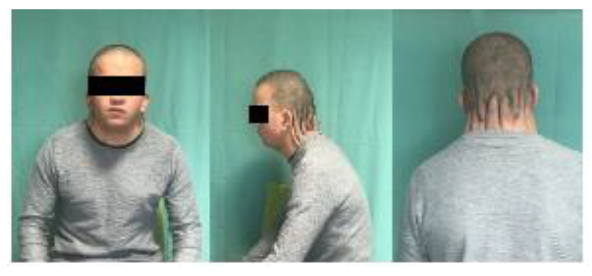 Surgical Management of Pterygium Colli with Significant Skin Laxity: A ...