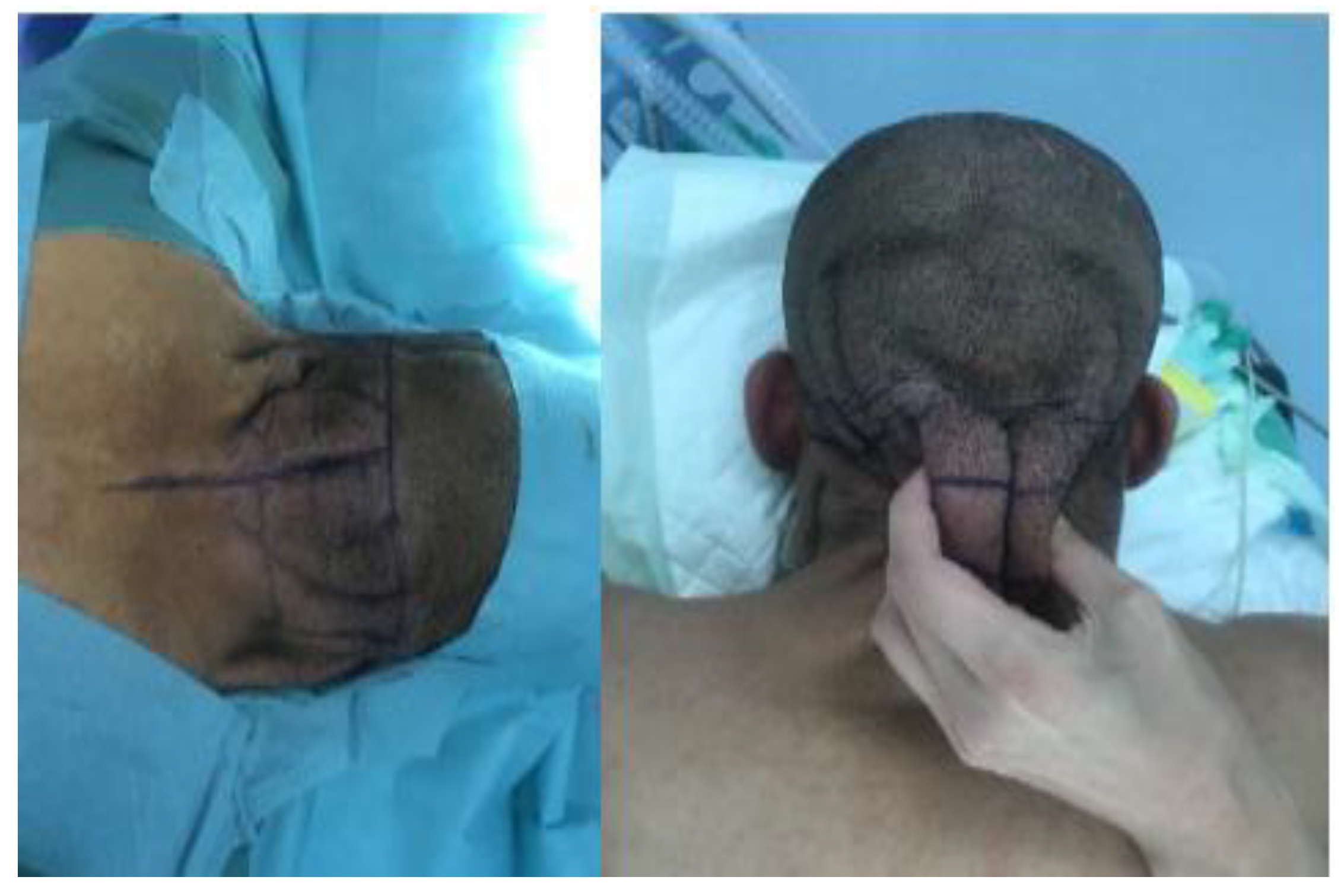 Surgical Management of Pterygium Colli with Significant Skin Laxity: A ...