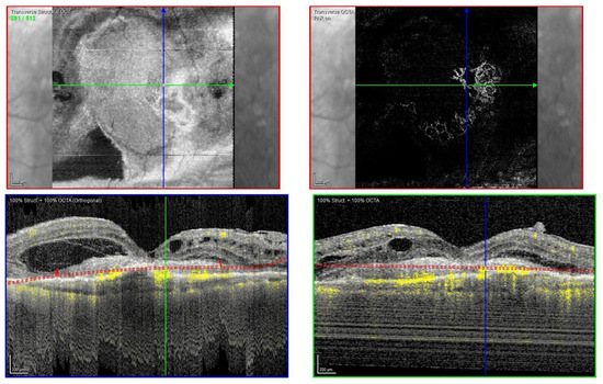 Bacillary Layer Detachment in Neovascular Age-Related Macular ...