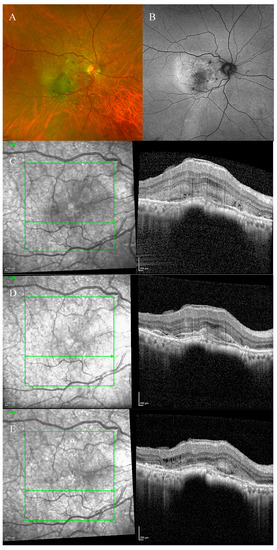 Bacillary Layer Detachment in Neovascular Age-Related Macular ...