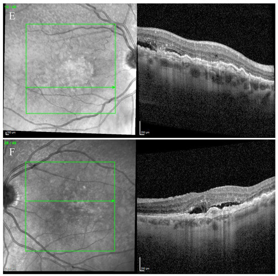 Bacillary Layer Detachment in Neovascular Age-Related Macular ...