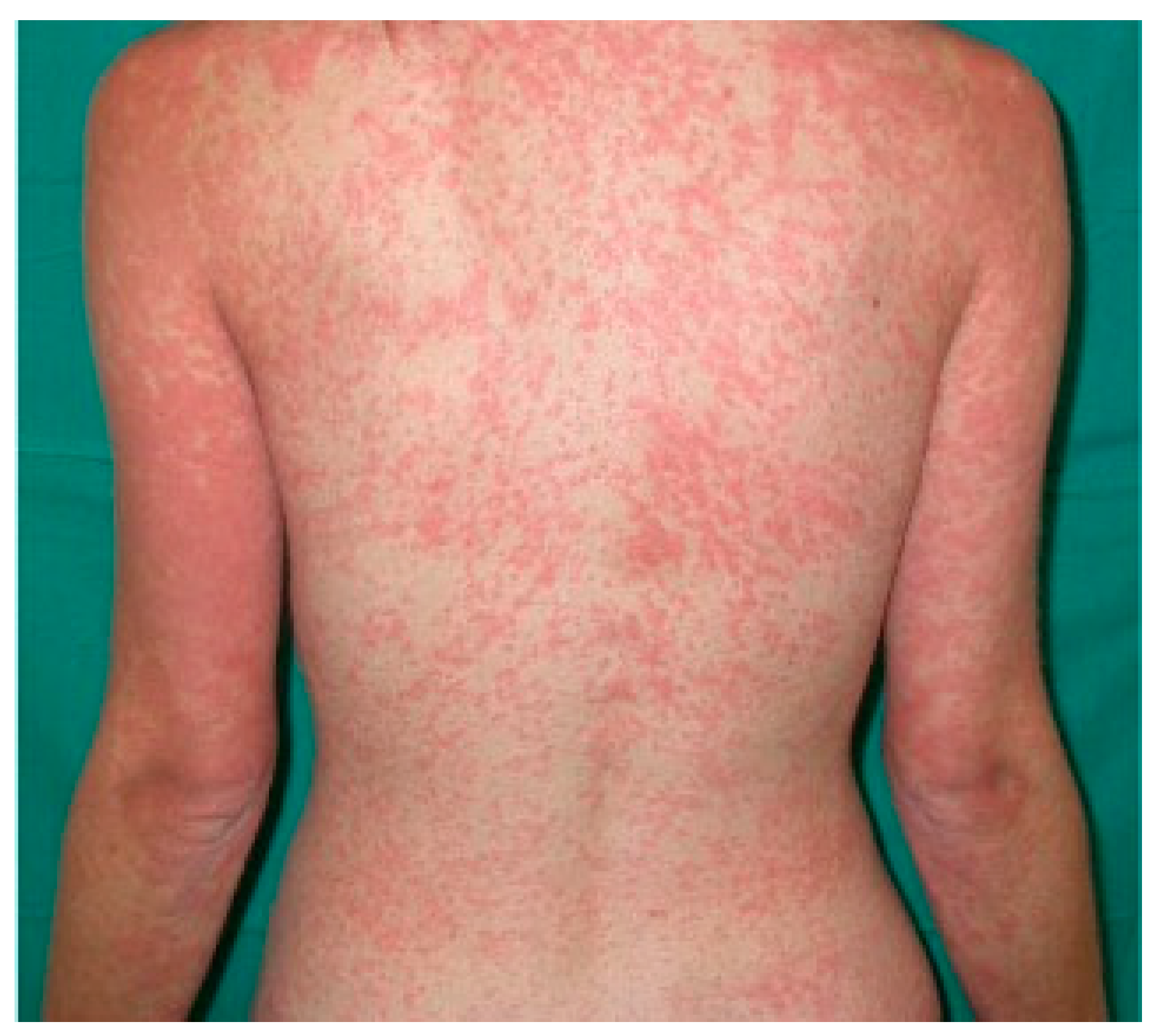 Erythematous Papular Rash