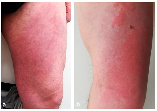 Urticaria: A Narrative Overview of Differential Diagnosis