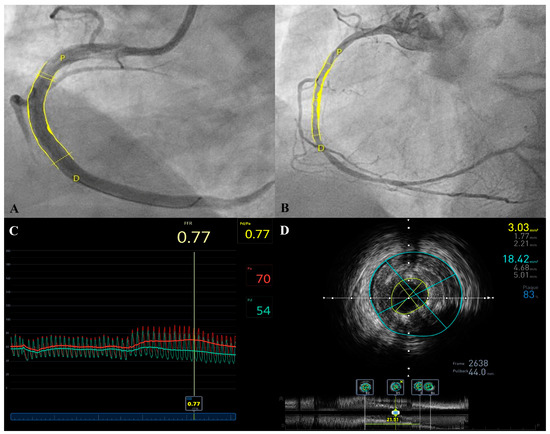 Bioresorbable Magnesium-Based Stent: Real-World Clinical Experience and ...